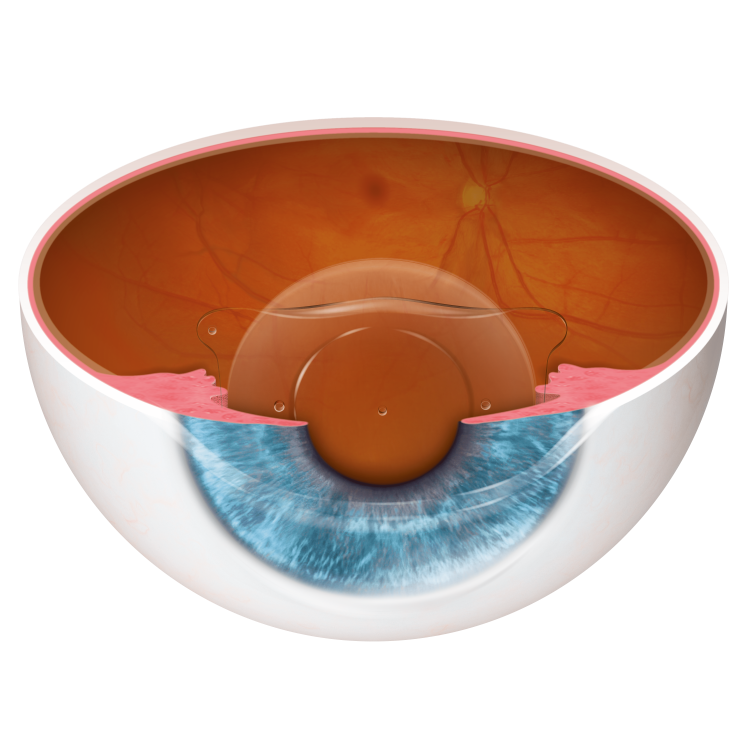 My EVO ICL Journey: A Personal Perspective | Women In Optometry