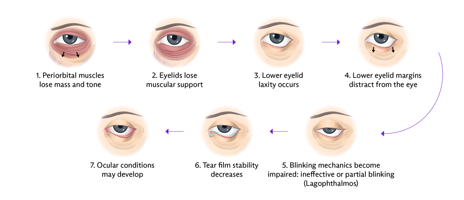 Behind OptiLIFT's Lid Laxity Innovation | Women In Optometry