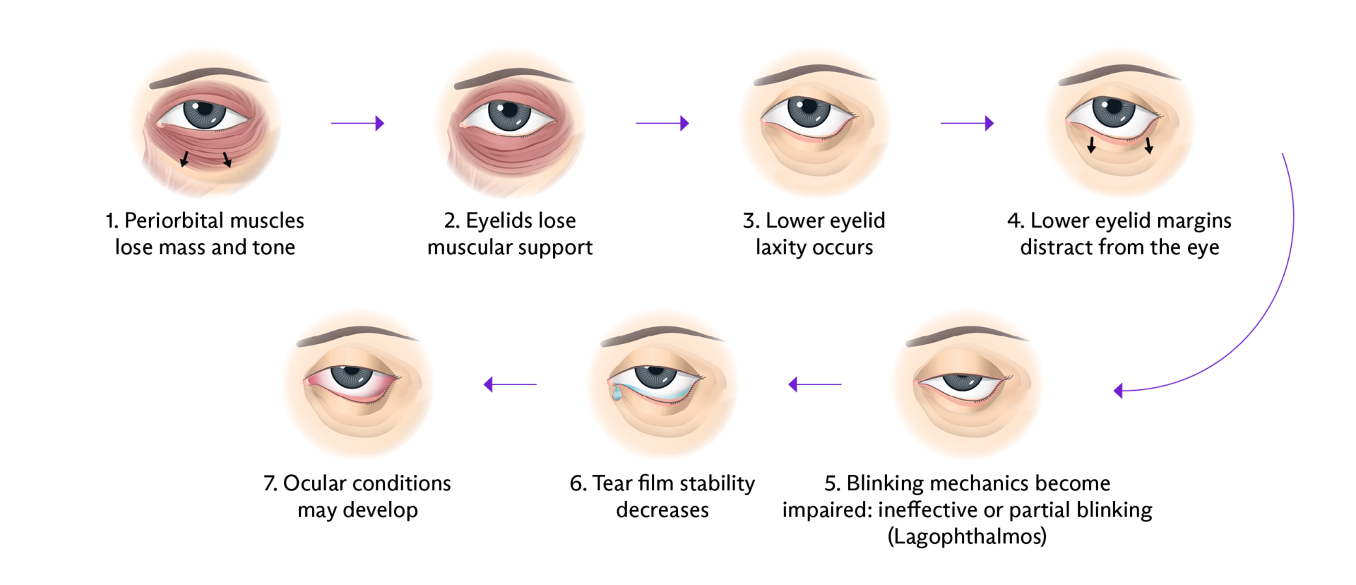 Behind OptiLIFT's Lid Laxity Innovation | Women In Optometry